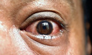 Mucormycosis (Black fungus) infection in eye: Facts and myths ...