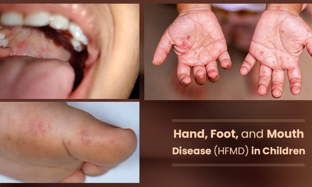 Hand Foot Mouth Disease Rash Symptoms - Infoupdate.org